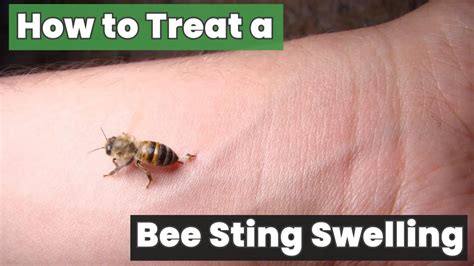 How To Treat A Bee Sting Swelling Instantly At Home Youtube