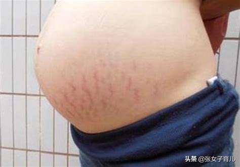 並不是所有孕媽都會有妊娠紋，那麼懷孕後，如何才能遠離妊娠紋呢 每日頭條