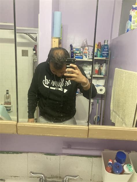 Diffuse Thinning Treatment Will Finasteride Help Rtressless