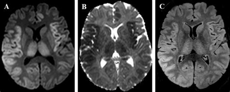 Hyperammonemia And Brain