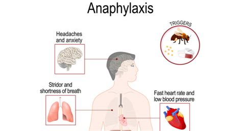 Anaphylaxis Diagnosis And Treatment