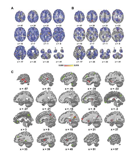 Areas Of Altered Functional Connectivity Activity In Depression Download Scientific Diagram