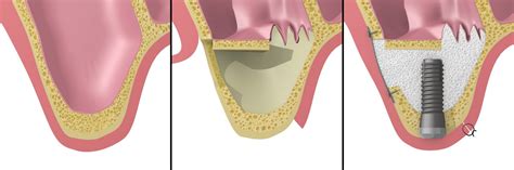 Dental Implants Vdental Implants Sinus Lift