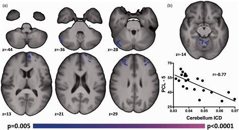Cerebellar And Prefrontal Cortical Alterations In Ptsd Structural And Functional Evidence