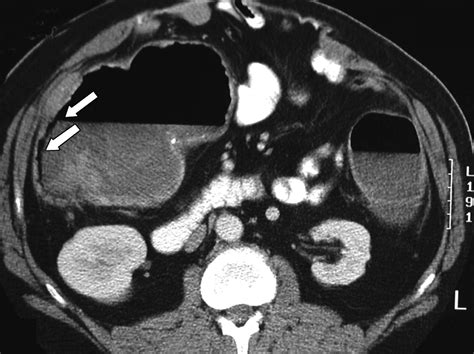 Thickening Of Ascending Colon Colon Wall Thickening Appearance