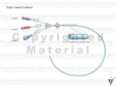 Case At A Glance Picc Line In Preemie — Illustrated Verdict