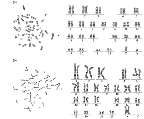 高分辨染色体核型分析 知乎