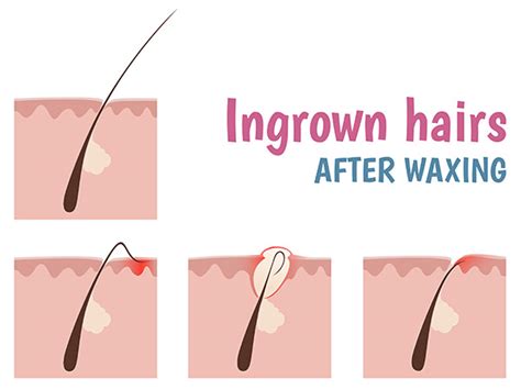 Side Effects Of Waxing You Should Know About