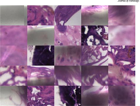 Figure From Differentiation Of Urothelial Carcinoma In Histopathology