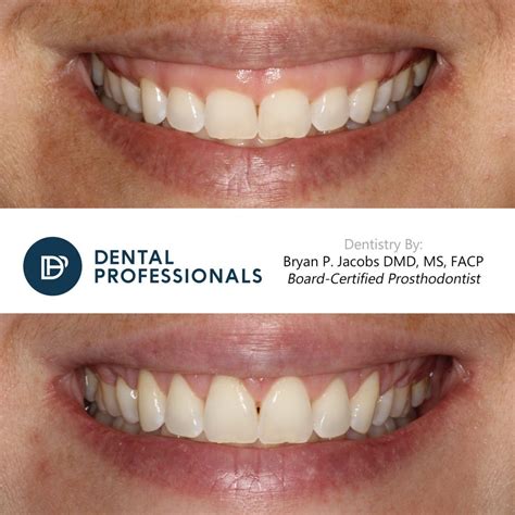 Gummy Smile Correction Chicago Gummy Smile Surgery Chicago South Loop