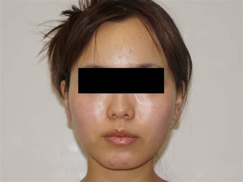 24歳女性 156㎝48㎏ 頬アゴ下ベイザー オトガイ脂肪注入 3か月まで シンシア総院長ブログ～sincerely Yours 銀座の