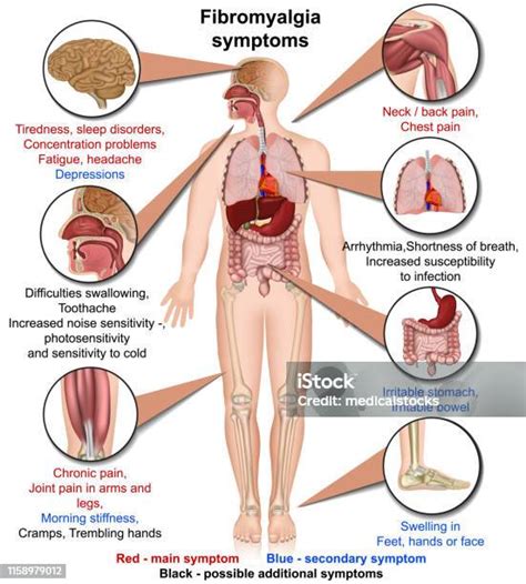 Ilustración De Síntomas De Fibromialgia Ilustración Vectorial Médica