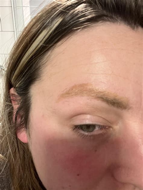 Microblading Removal R Microbladingremoval