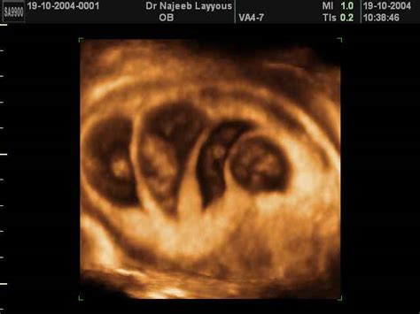 3d Ultrasound Scan Photos Of Multiple Pregnancy Twins Triplets