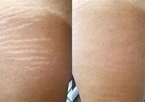 Give Your Stretch Marks A Makeover The Tattoo Solution Thaiger