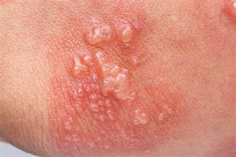 Shingles Zoster Or Herpes Zoster Symptoms On Arm Stock Image Image