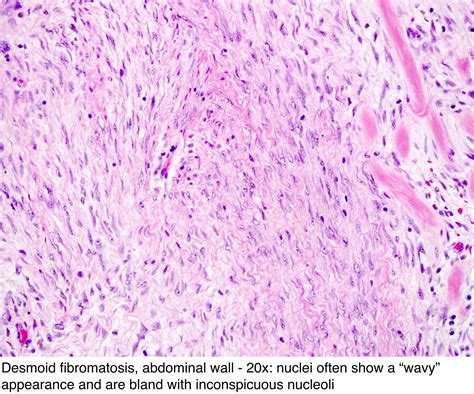 Spindle Cells Desmoid Tumor At Ella Byatt Blog