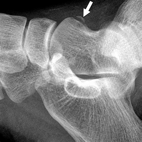 Calcaneocuboid Dislocation