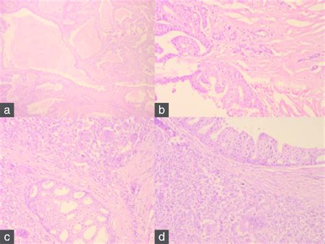 A Section Showing Intraductal Component Of The Salivary Duct