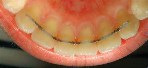 Composite Lỏng Microfil Quang Trùng Hợp Flow Tain Doe Việt Nam