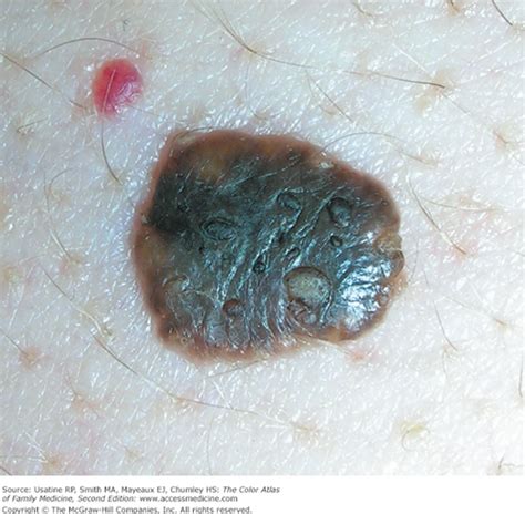 Seborrheic Keratosis Basicmedical Key