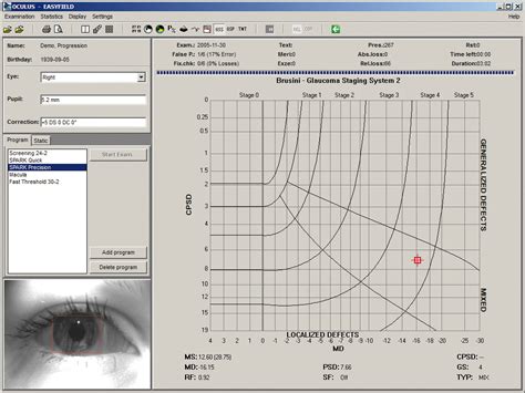 Smartfield Compact Visual Field Device Oculus Germany