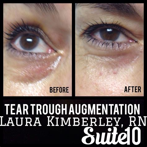 Before And After Tear Trough Augmentation With Belotero For Improvement Of Under Eye Circles