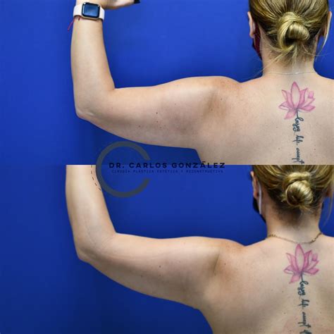 Braquioplastia Antes y después Multiestetica mx Multiestetica mx