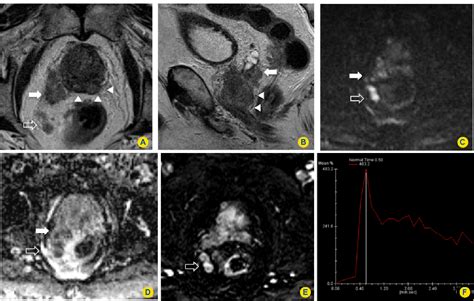 Figure 4 From The Role Of Multiparametric Magnetic Resonance Imaging