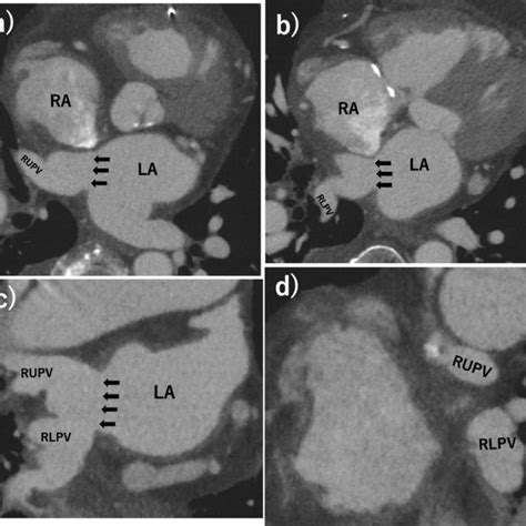 Preoperative Multidetector Computed Tomography Angiography