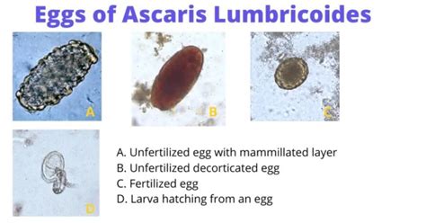 Ascaris Lumbricoides Life Cycle Pathogenesis Lab Diagnosis