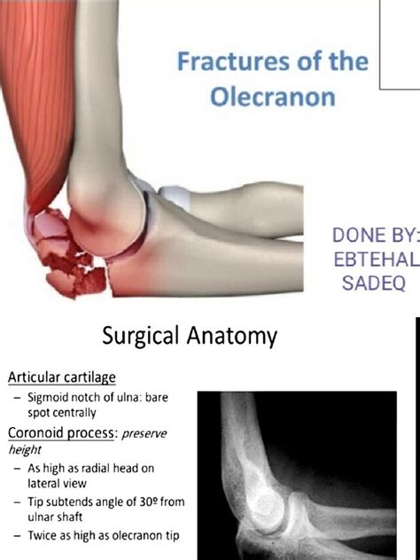 Olecranon Fracture Pdf