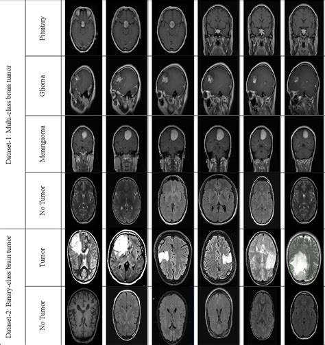 Figure 3 From The Deep Learning Model For The Examination Of Brain Tumor Semantic Scholar