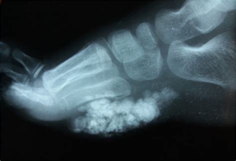 What Do Calcium Deposits On Feet Look Like At Kathleen Perry Blog