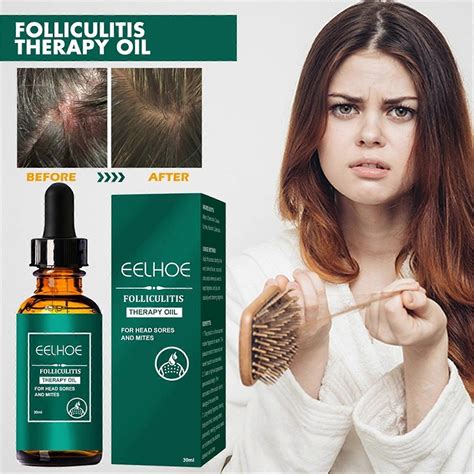Scalp Folliculitis Oil Scalp Hair Oil Natural Hair And Scalp Oil