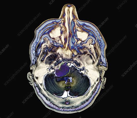 Meningioma Brain Cancer Mri Scan Stock Image C0388666 Science