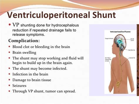 Head Shunts In Adults Ventriculoperitoneal Shunt Types Procedure