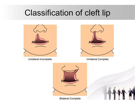 Cleft Lip And Palateppt
