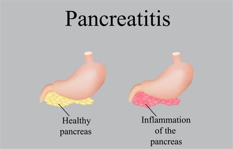 Pancreatitis Diet A Complete Recovery Diet Chart To Follow Artofit