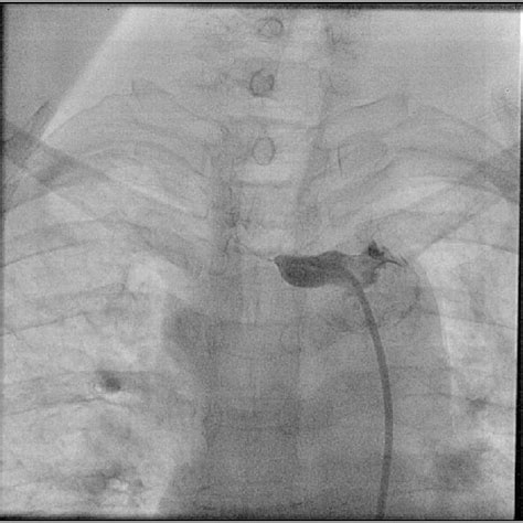 Peripheral Angiogram Showing Aberrant Right Subclavian Artery Total