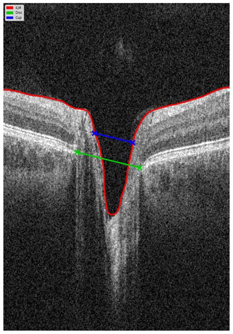 Ai Oct Optic Disc Analysis For Assessing Risk Of Glaucoma