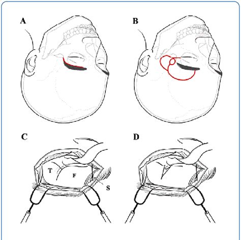 1 Modified Lateral Supraorbital Mlso Approach A Trans Eyebrow Skin