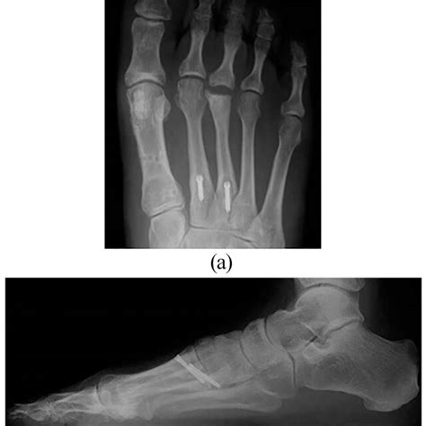 Weight Bearing Radiographs Obtained At 1 Year After Surgery No