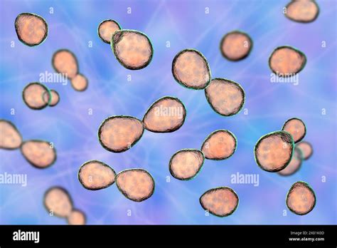 Eye Disease Histoplasmosis Astigmatism Glaucoma Swollen
