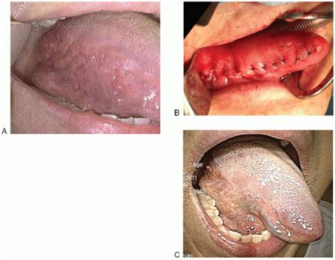 Operative Considerations And Techniques For Partial Glossectomy Ento Key