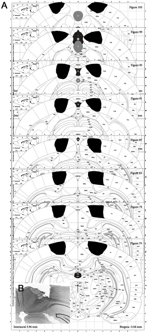 A Summary Of Lesion Boundaries Medial Extrastriate Visual Cortex