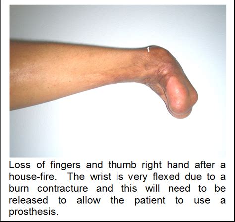 Stump Revision Royal Free London Private Patient Unit