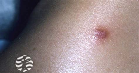 Cat Scratch Disease Image