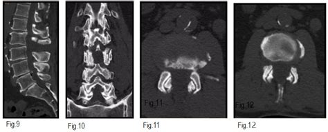 Lumbar Tubular Decompression Through An Interspinous Midline Approach With Microscopic