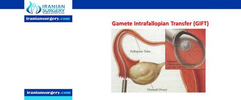 Gamete Intrafallopian Transfer T Iranian Surgery